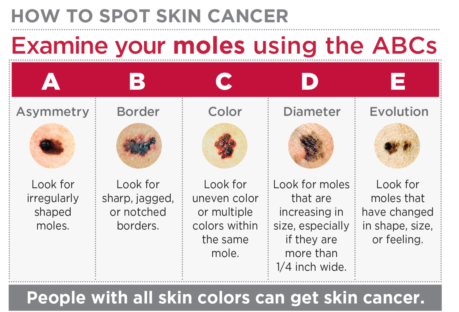 Do You Know the ABCDEs of Skin Cancer? - eHealth Connection