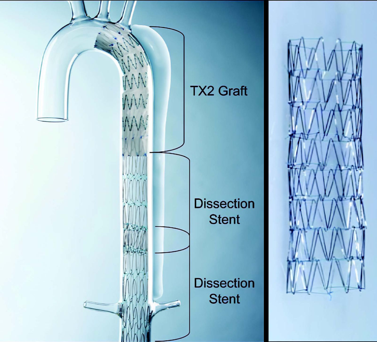 Cooper Aortic Center Among First in Nation to Offer New Endovascular ...