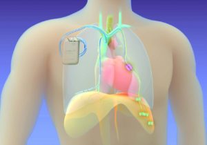 Cooper Offers Innovative Therapy for Patients with Central Sleep Apnea ...